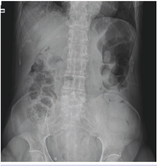 (PDF) Adult sigmoid intussusception as a rare presentation of advanced ...